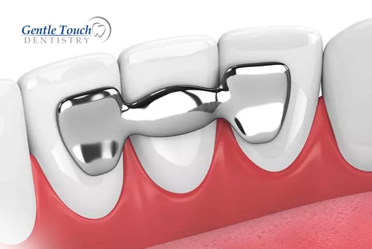 Dental Bridges: Your answer to a lovely smile!