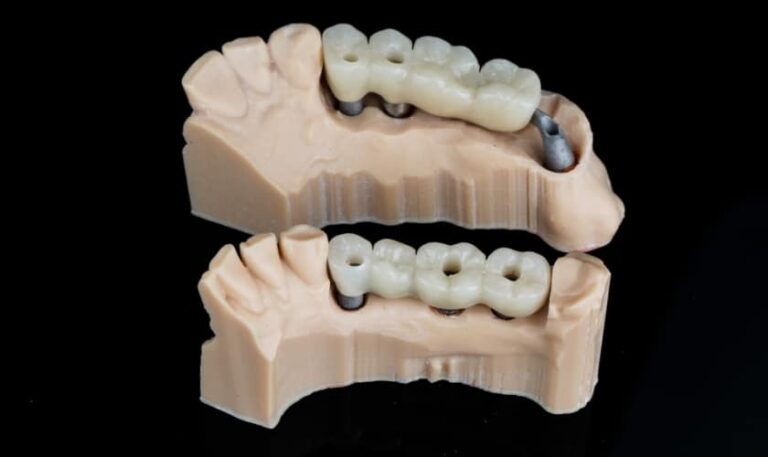 5 Essential Tips For Proper Dental Bridge Aftercare